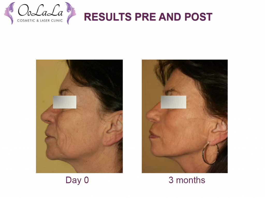 Thread Lifts - What You Need To Know - Oo La La Cosmetic Laser Clinic