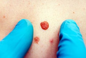Skin Tags & Moles - Oo La La Cosmetic & Laser Clinic