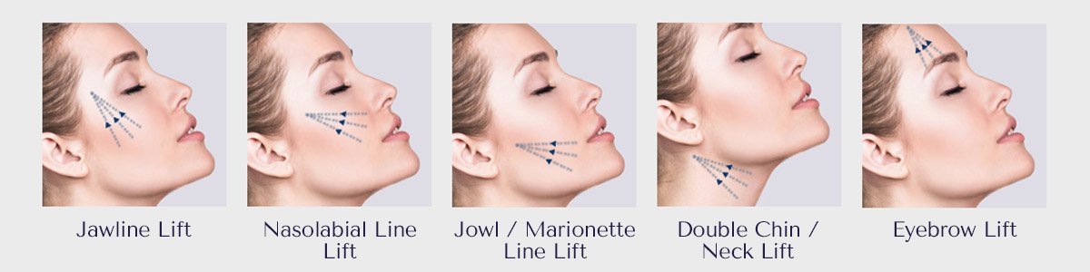 Thread Lifts Gold Coast - Oo La La Cosmetic & Laser Clinic